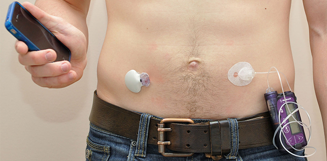 Dexcom Partners with Verily to Develop Second Generation CGM System